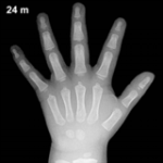 Radiografía EDAD ÓSEA | Radiología La Serena